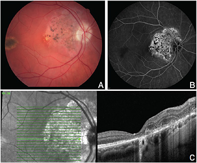 New Retinal Physician | PentaVision