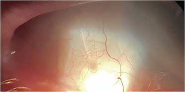 New Retinal Physician | PentaVision