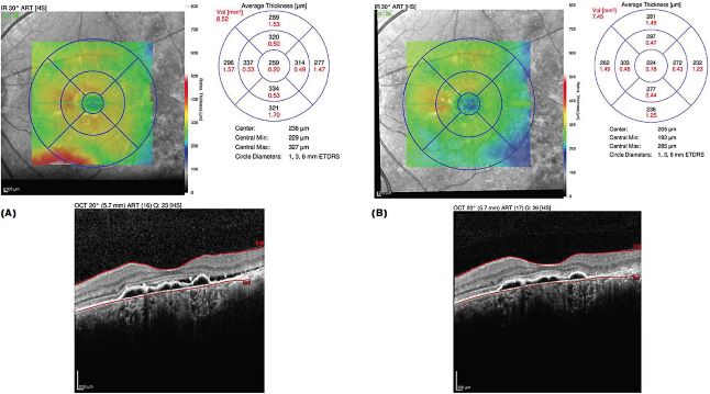 New Retinal Physician | PentaVision
