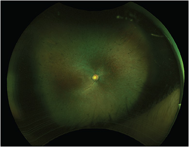 New Retinal Physician | PentaVision