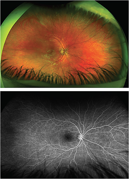 New Retinal Physician | PentaVision
