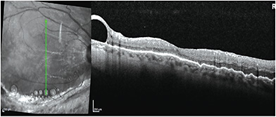 New Retinal Physician | PentaVision