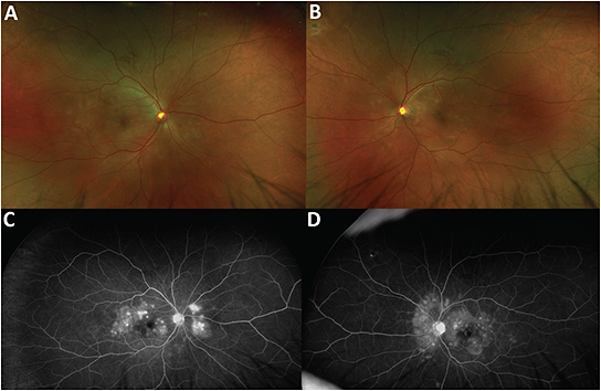 New Retinal Physician | PentaVision