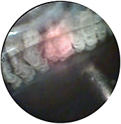 New Retinal Physician | PentaVision