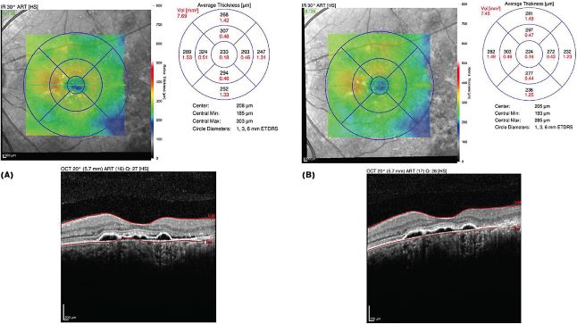 New Retinal Physician | PentaVision