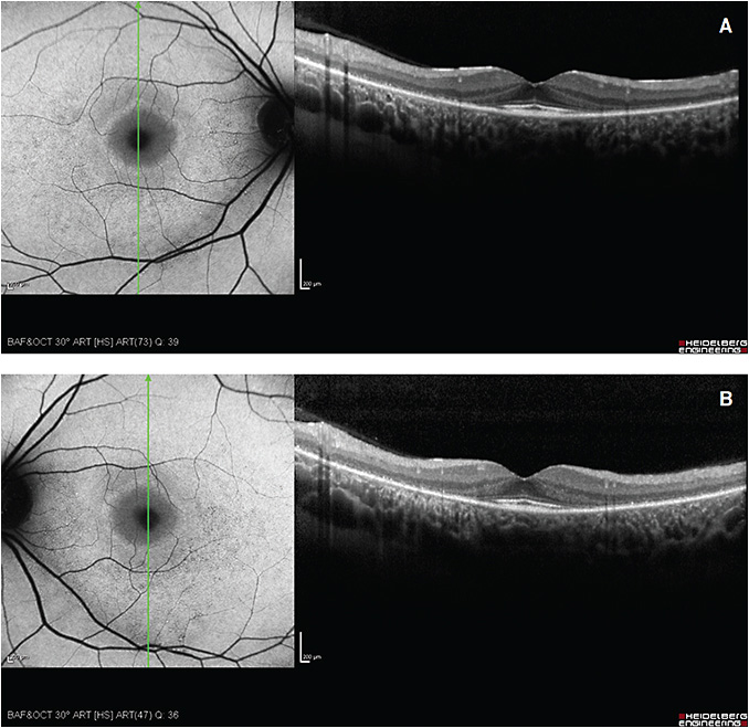 New Retinal Physician | PentaVision
