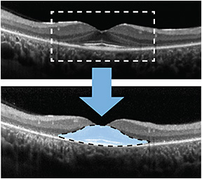 New Retinal Physician | PentaVision